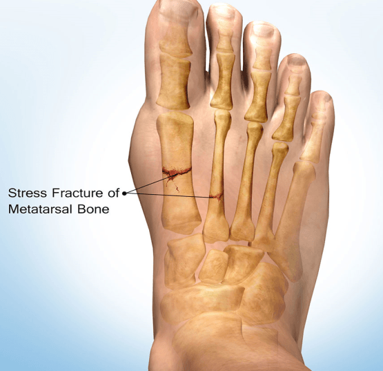 Metatarsal Stress Fracture - Mount Lawley Physiotherapy