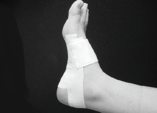 Low Dye Taping - Mount Lawley Physiotherapy
