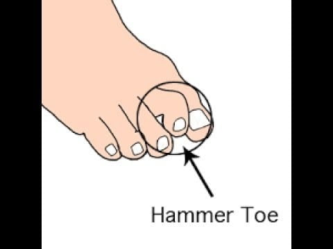 Hammertoe Deformity - Mount Lawley Physiotherapy